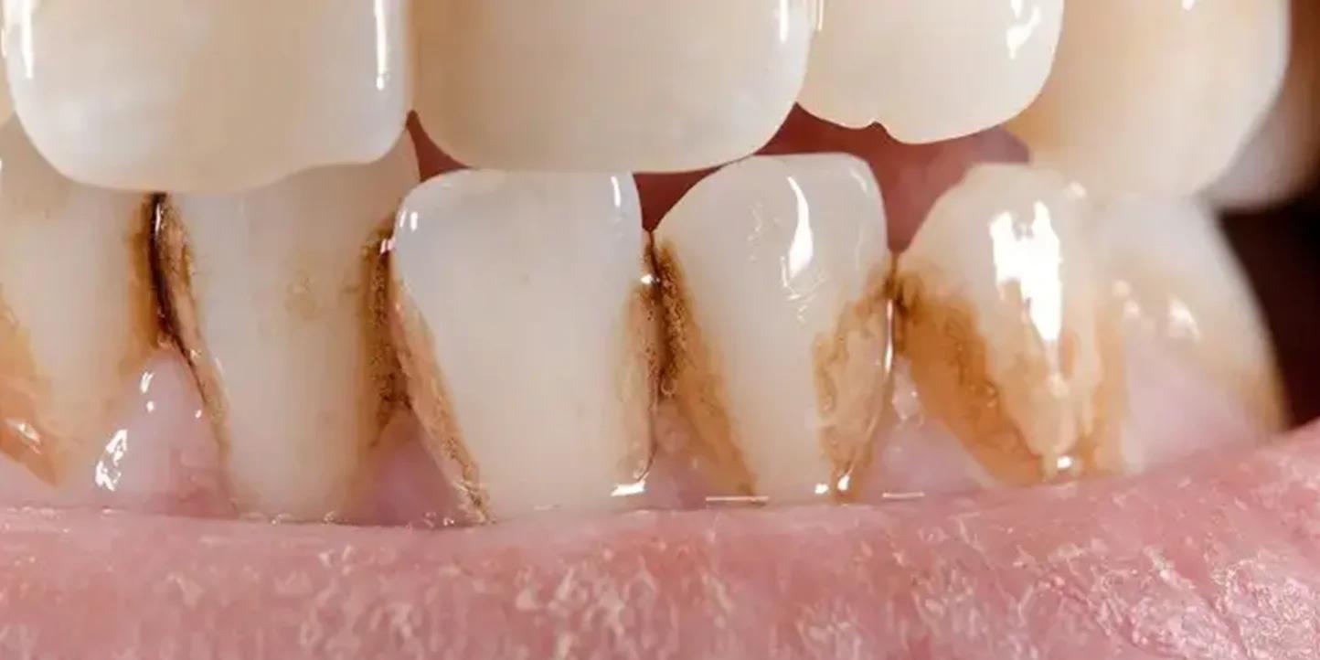 Manchas De Café En Los Dientes: Causas Y Soluciones | Despiste Café