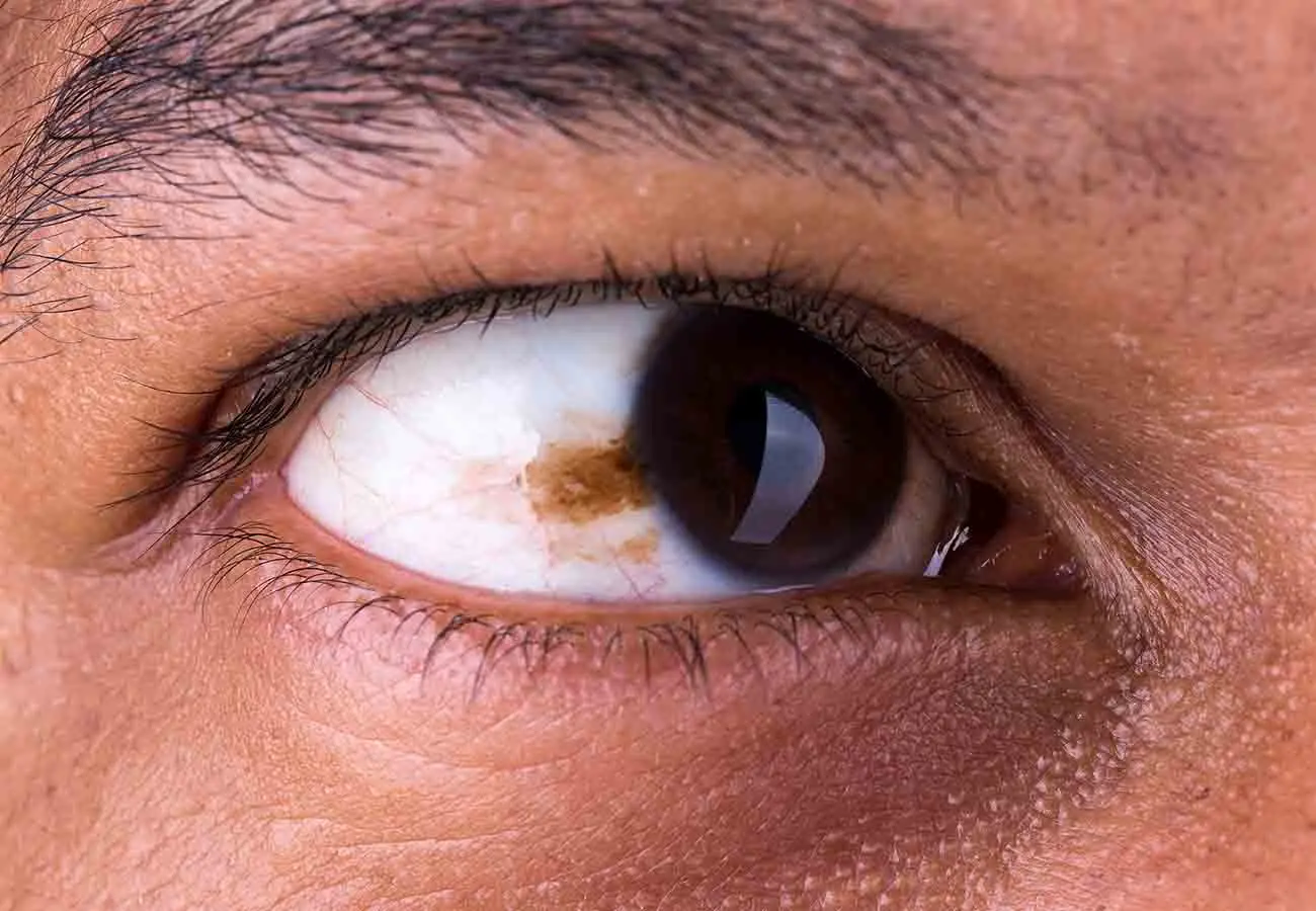 Manchas Café Alrededor De Los Ojos: Causas Y Tratamientos | Despiste Café